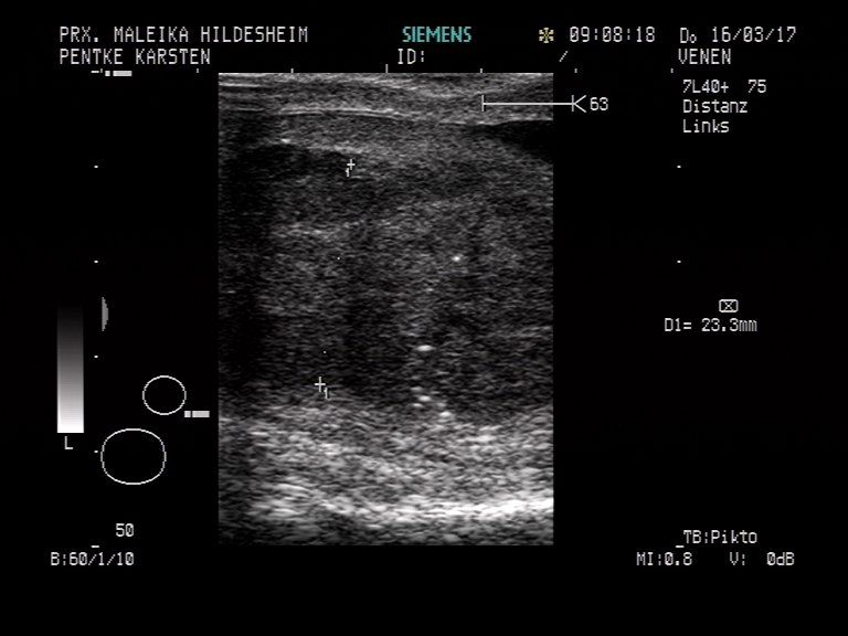 Seminom - Hausarzt Hildesheim